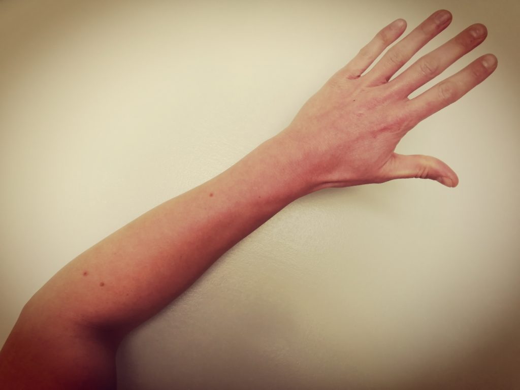 Pinchy nerve with pain to the arm?? - Bury Physio